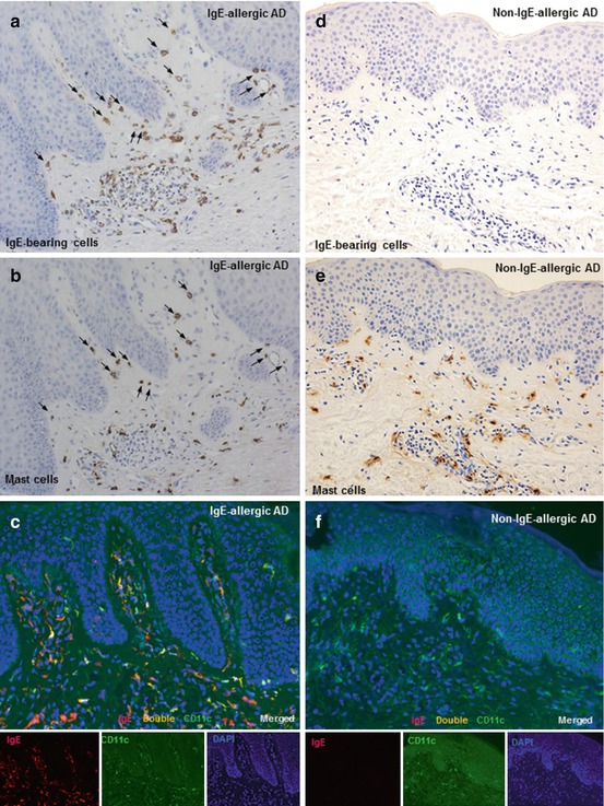 Senile Atopic Dermatitis | SpringerLink