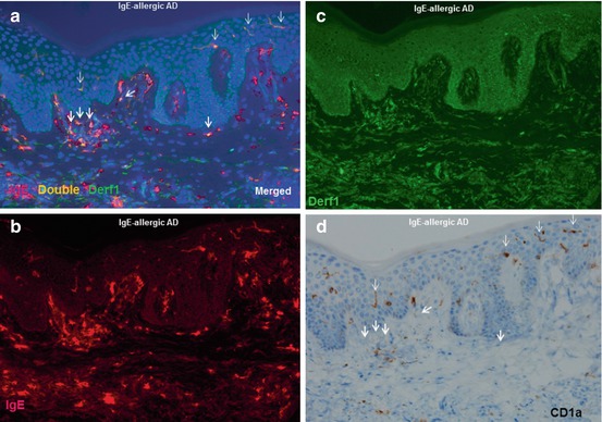 Senile Atopic Dermatitis | SpringerLink
