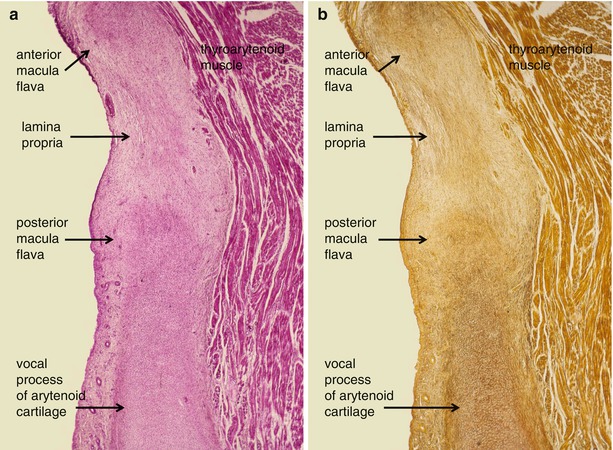 Macula Flava of the Human Newborn Vocal Fold | SpringerLink