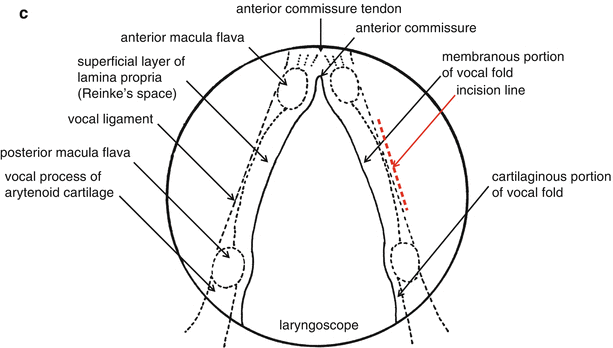 Clinical Anatomy of the Human Larynx | SpringerLink