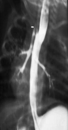 Esophageal Atresia | SpringerLink