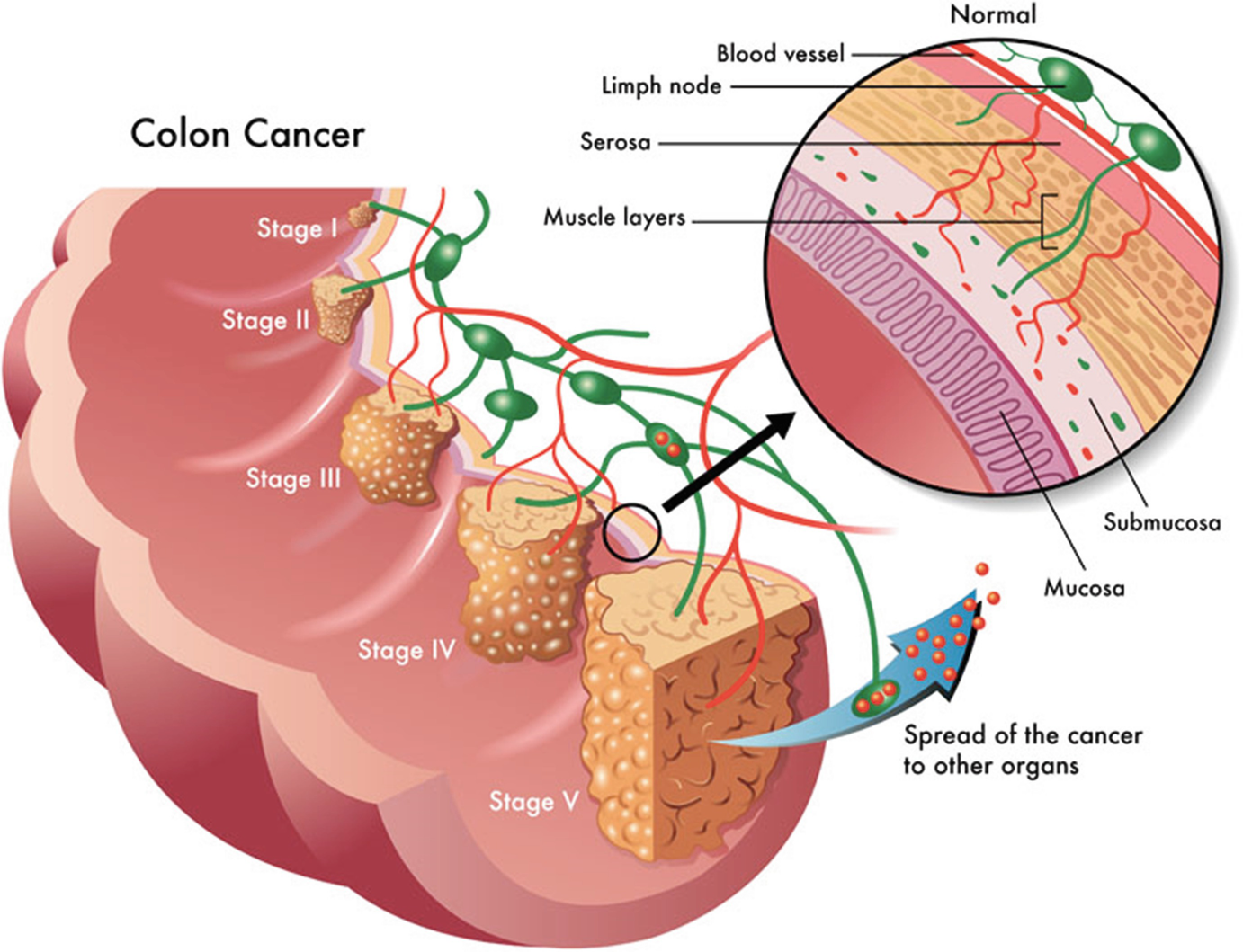 Role of STAT3 in Colorectal Cancer Development | SpringerLink