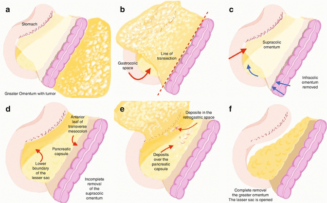 Cytoreductive Surgery for Peritoneal Metastases: Principles and ...