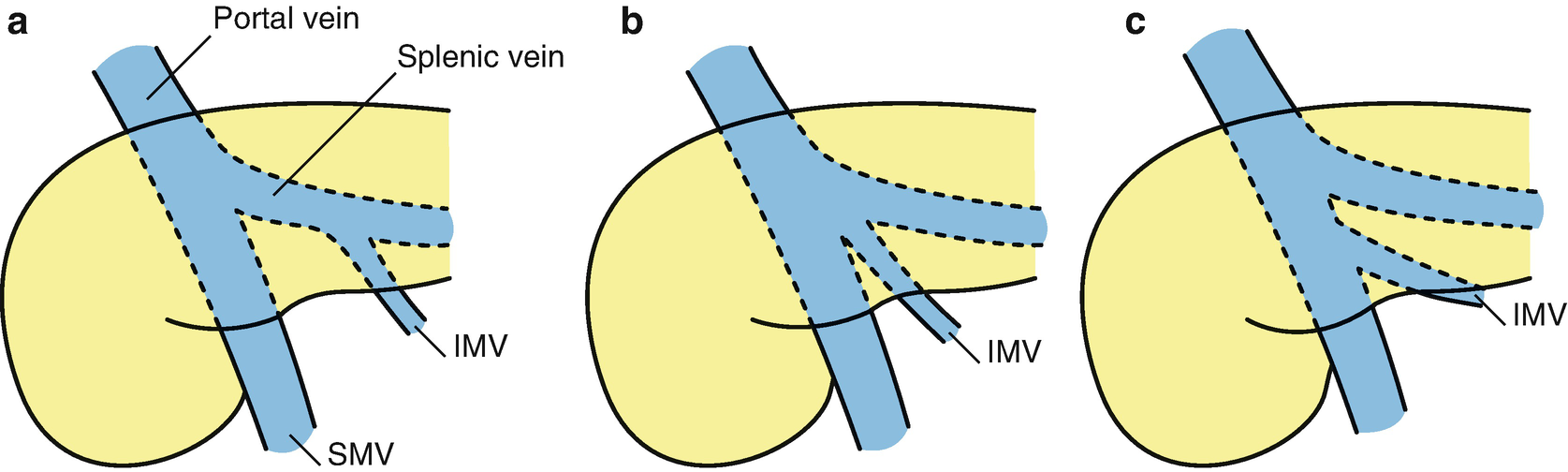 Surgical Anatomy of the Pancreas and the Periampullary Region ...