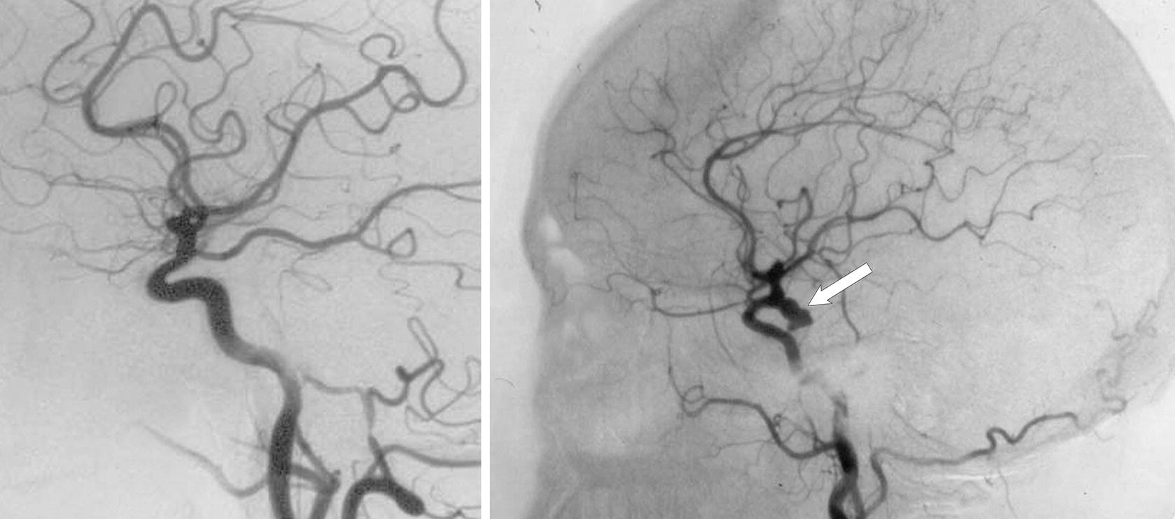 Pcom Aneurysm with Oculomotor Nerve Palsy (ONP) | SpringerLink