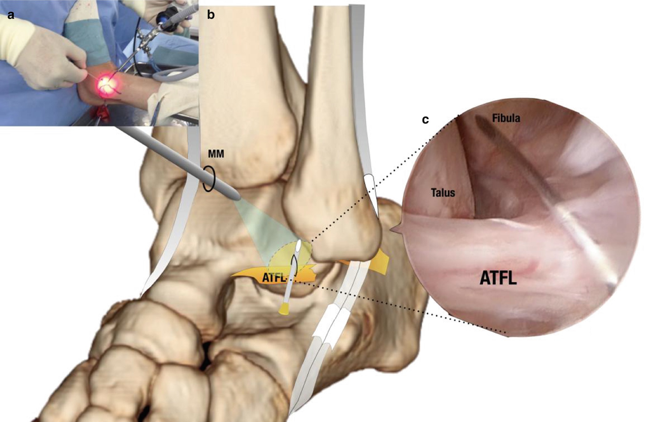 Ankle Arthroscopy: Soft Tissue Procedures | SpringerLink