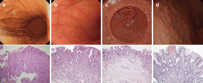 Atrophic Gastritis and Intestinal Metaplasia | SpringerLink