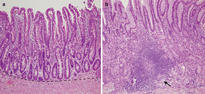 Histopathologic Diagnosis of H. pylori Infection and Associated Gastric ...