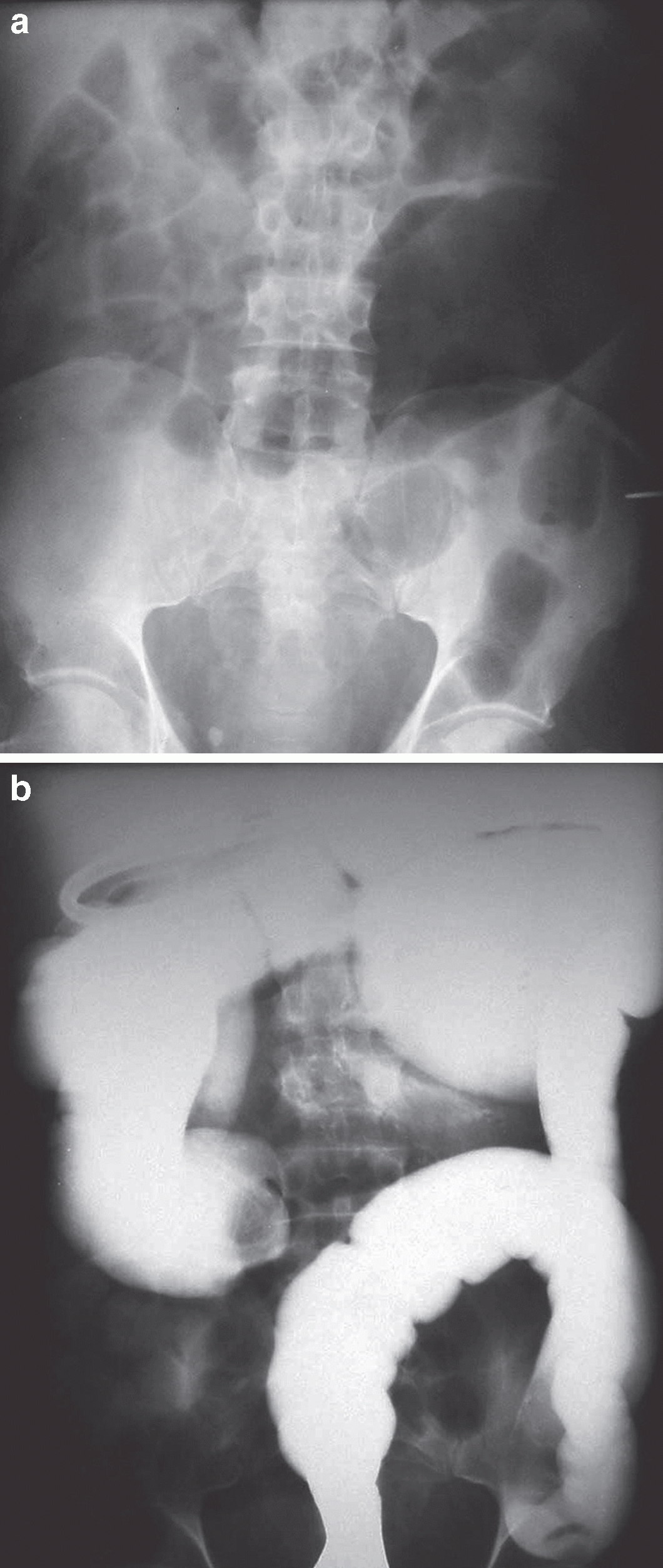 Colonic Volvulus | SpringerLink