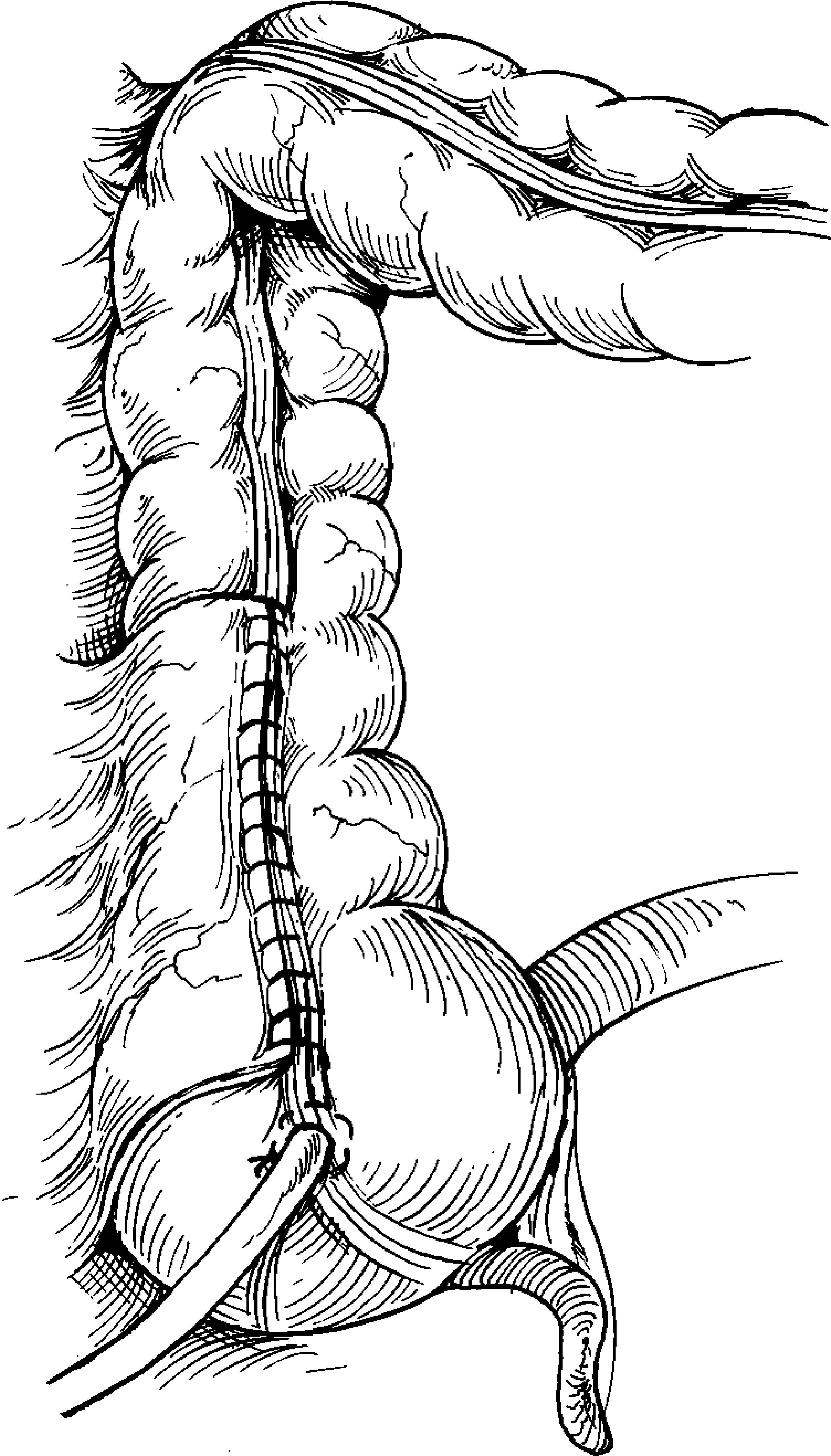 Colonic Volvulus | SpringerLink