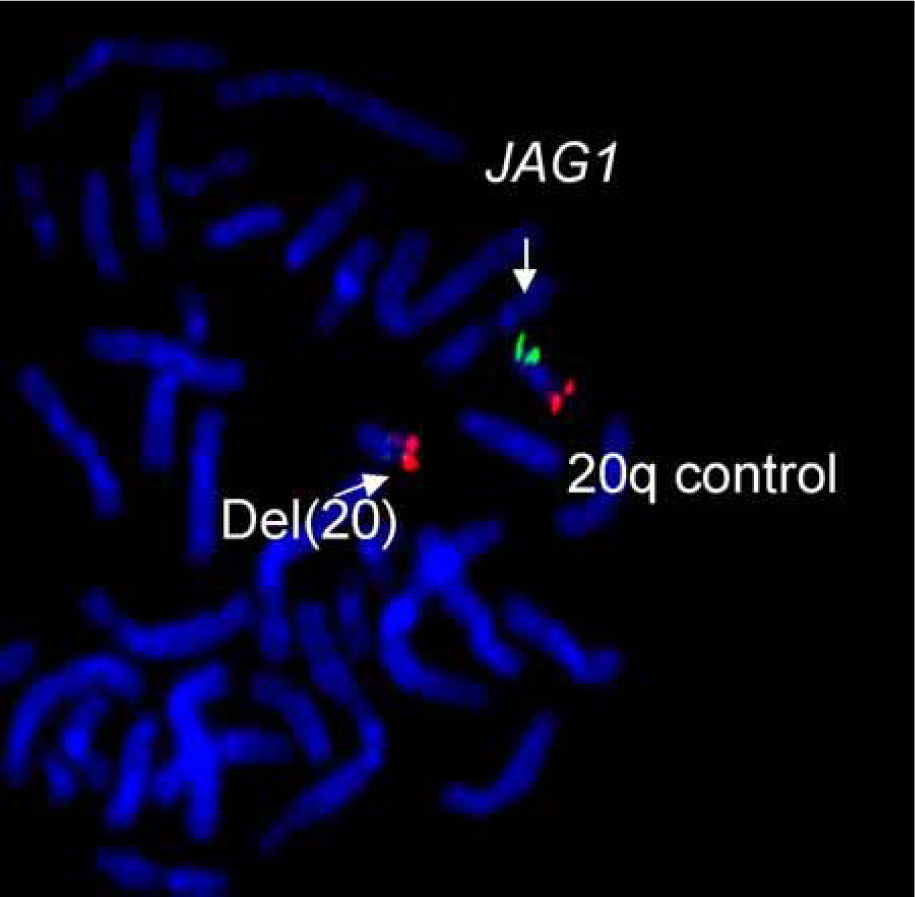 The Cardiovascular Manifestations of Alagille Syndrome and JAG1 ...