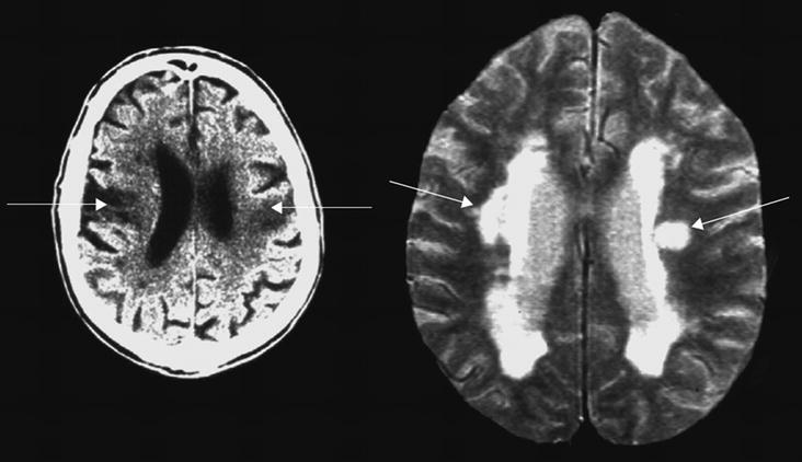 Neurology of Swallowing and Dysphagia | SpringerLink