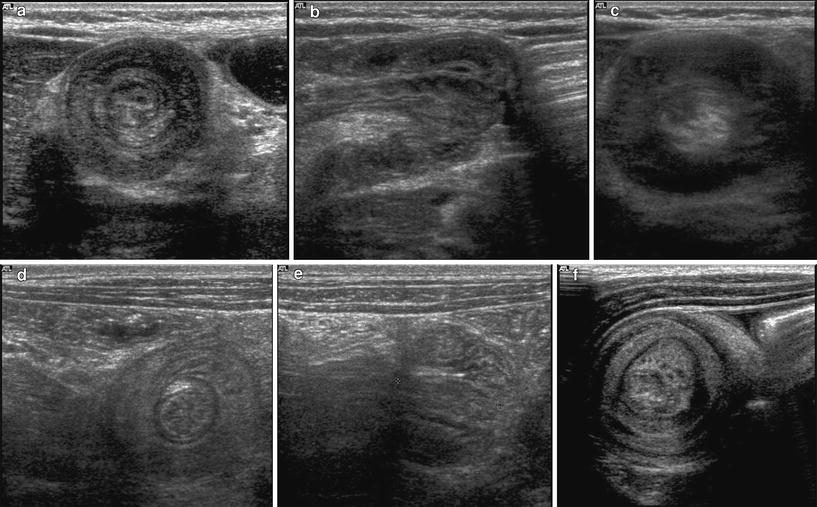 Abdominal Hernias, Volvulus, and Intussusception | SpringerLink