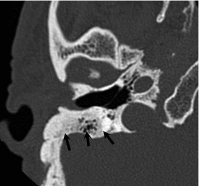 Chronic Otomastoiditis without Cholesteatoma | SpringerLink