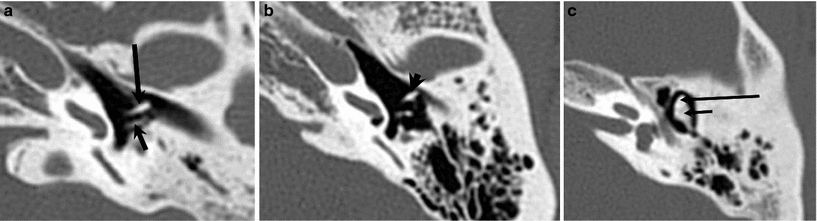Chronic Otomastoiditis without Cholesteatoma | SpringerLink