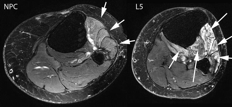 MRI of Muscle Denervation in Central and Peripheral Nervous System ...