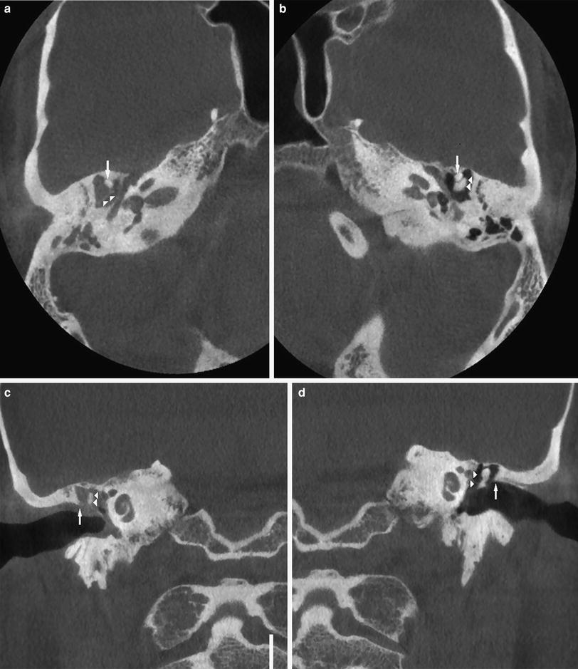 Imaging of Cholesteatoma | SpringerLink