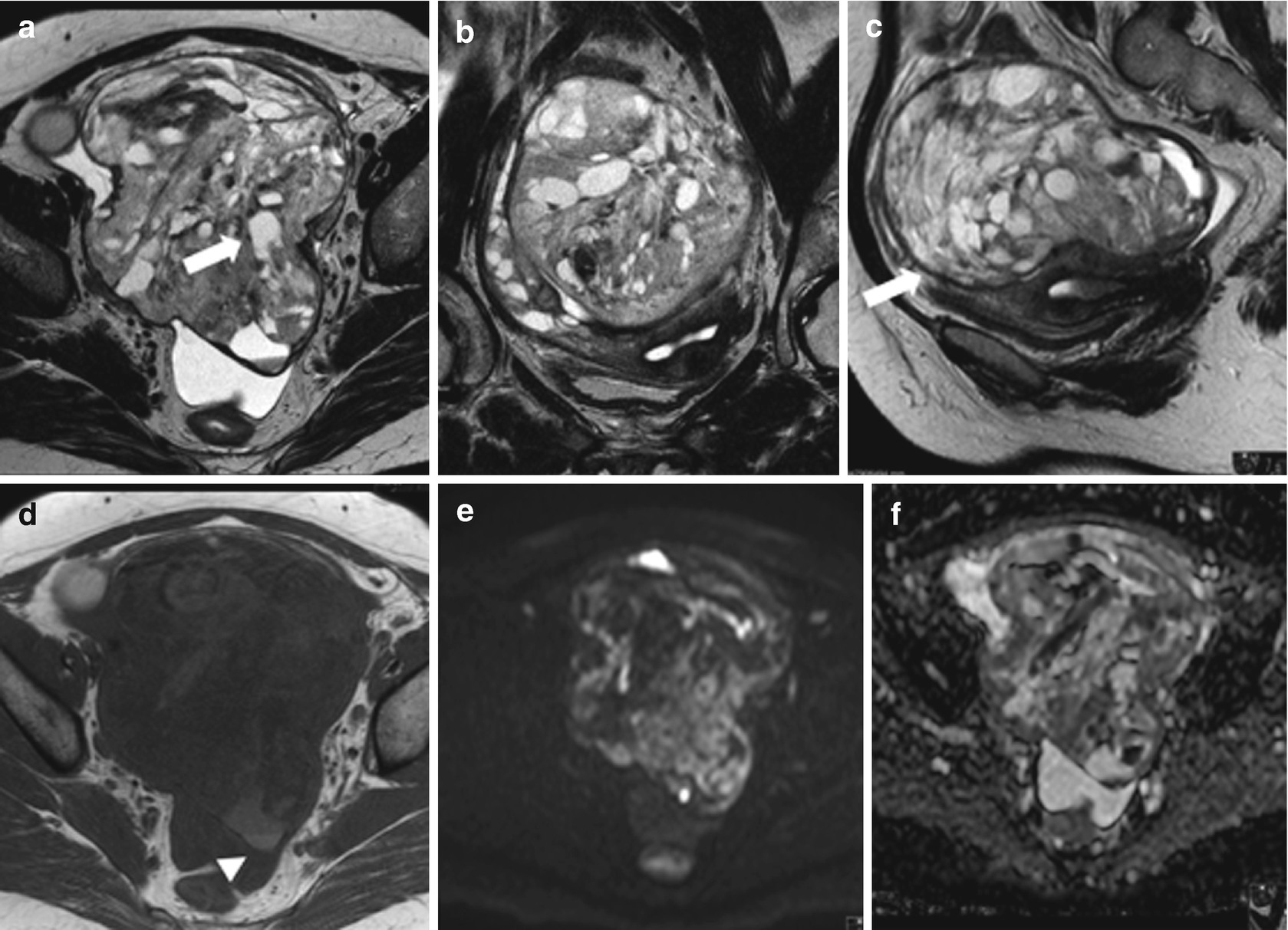 Uterine Sarcomas | SpringerLink