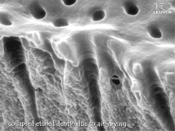 Bonding to Dentin: Smear Layer and the Process of Hybridization ...