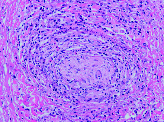 The Histopathology of IgG4-Related Disease | SpringerLink