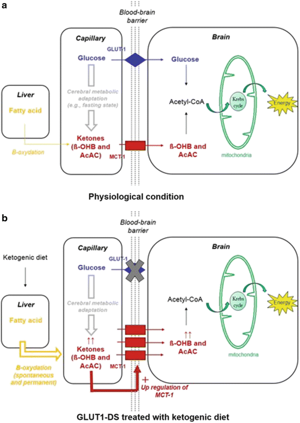 A Cause of Permanent Ketosis: GLUT-1 Deficiency | SpringerLink