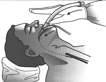 The Laryngeal Mask Airway (LMA™) and Other Extraglottic (Supraglottic ...