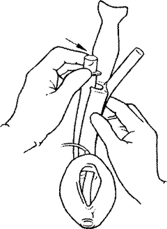 The Laryngeal Mask Airway (LMA™) and Other Extraglottic (Supraglottic ...