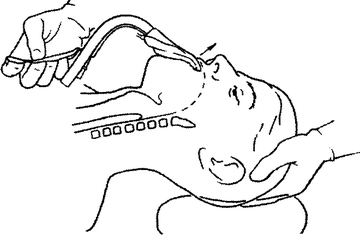 The Laryngeal Mask Airway (LMA™) and Other Extraglottic (Supraglottic ...
