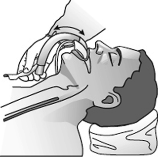 The Laryngeal Mask Airway (LMA™) and Other Extraglottic (Supraglottic ...