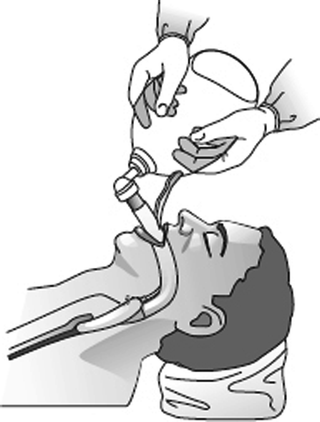 The Laryngeal Mask Airway (LMA™) and Other Extraglottic (Supraglottic ...