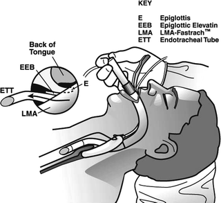 The Laryngeal Mask Airway (LMA™) and Other Extraglottic (Supraglottic ...