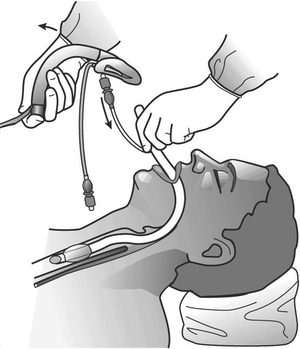 The Laryngeal Mask Airway (LMA™) and Other Extraglottic (Supraglottic ...
