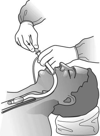 The Laryngeal Mask Airway (LMA™) and Other Extraglottic (Supraglottic ...
