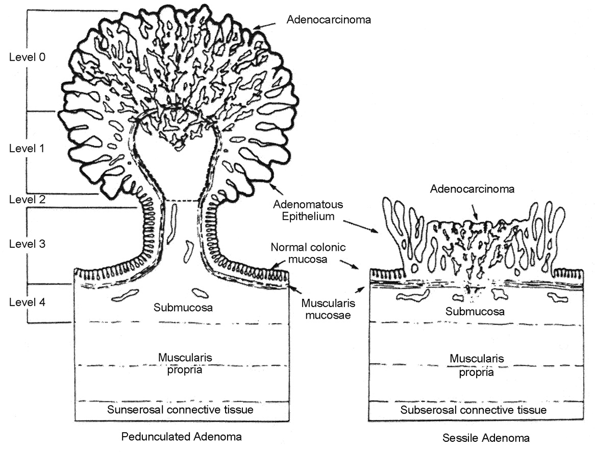 Polyps | SpringerLink