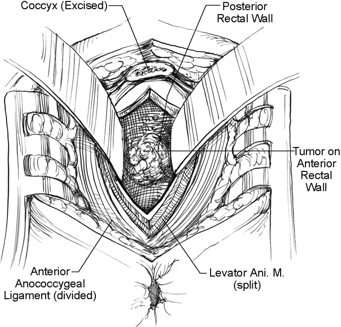 Surgical Treatment of Rectal Cancer | SpringerLink