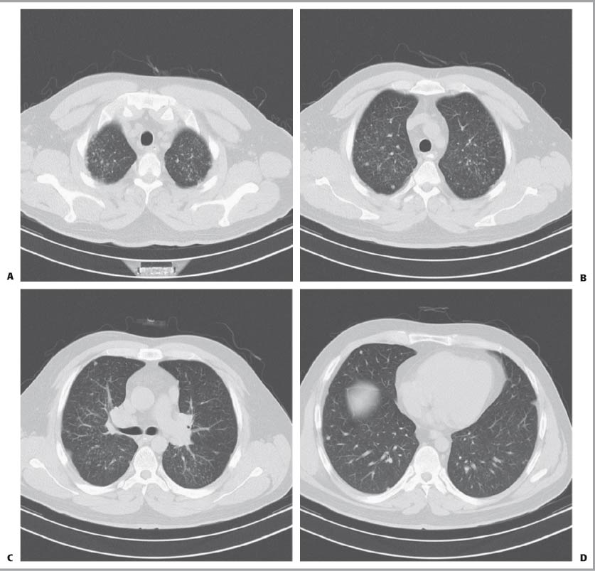 Sarcoidosis | SpringerLink