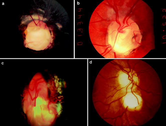 Congenital Optic Disc Anomalies | SpringerLink