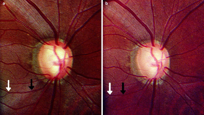 Evaluating the Optic Nerve for Glaucomatous Progression | SpringerLink
