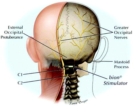 The Bion® Microstimulator and its Clinical Applications | SpringerLink