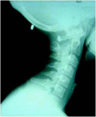 The Bion® Microstimulator and its Clinical Applications | SpringerLink