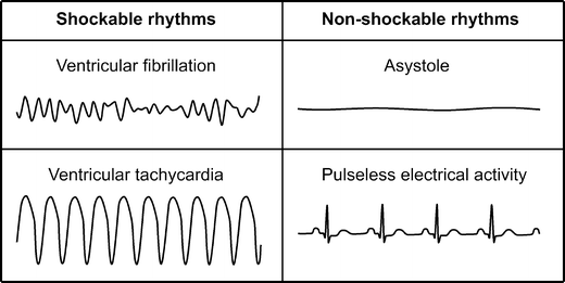 Cardiopulmonary Resuscitation | SpringerLink