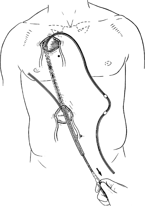Peritoneal Dialysis Access and Exit-Site Care Including Surgical ...
