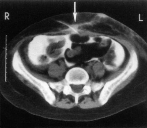 Peritoneal Dialysis Access and Exit-Site Care Including Surgical ...