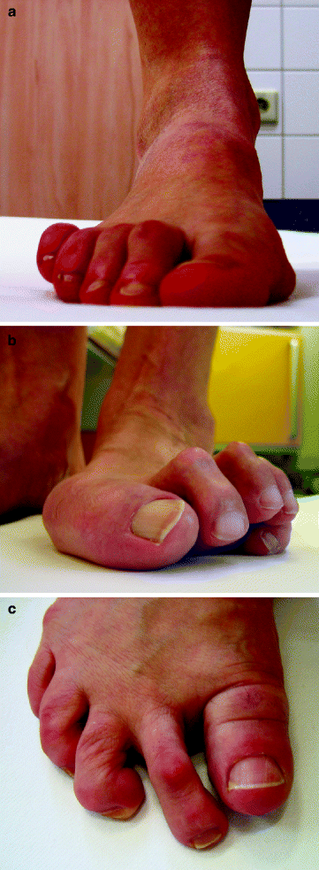 Surgical Treatment of Hammer Toe, Claw Toe, and Mallet Toe Deformity ...