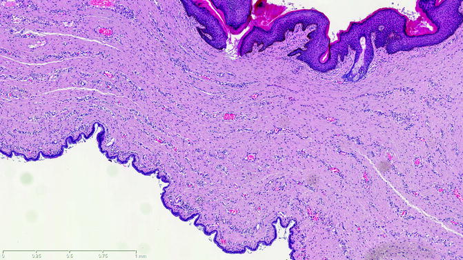 Cysts, Non neoplastic Glandular Lesions, and Glandular Neoplasms of the ...
