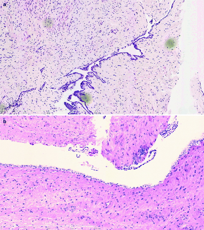 Cysts, Non neoplastic Glandular Lesions, and Glandular Neoplasms of the ...