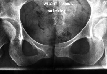 Pubic Symphysis Fusion | SpringerLink