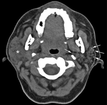 Diagnostic Procedures (II): Parotid Scintigraphy, Parotid Ultrasound ...