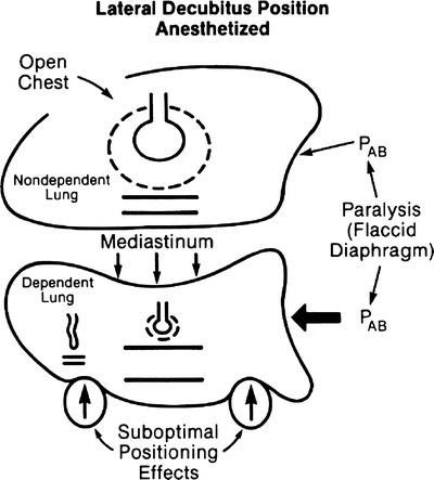 Physiology of the Lateral Decubitus Position, Open Chest and One-Lung ...