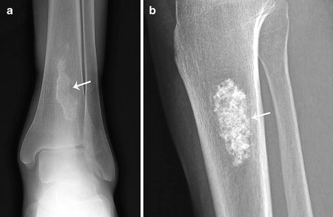 Bone Tumor Mimickers | SpringerLink